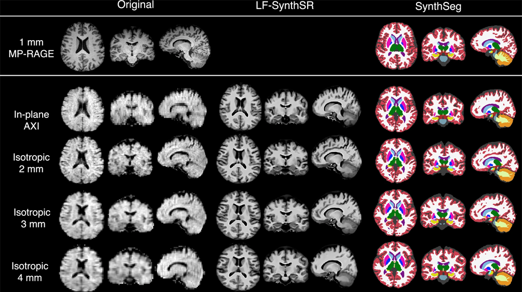 Portable MRI, enhanced by AI, proves viable in brain imaging for ...